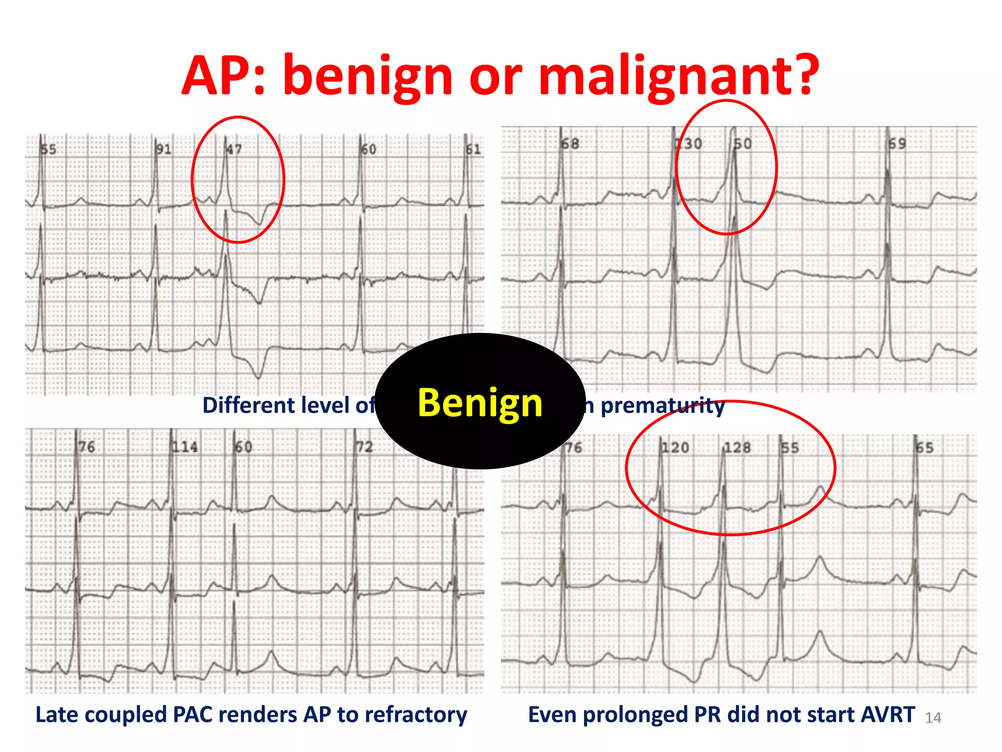 Supraventricular tachycardia: ECG recognition and diagnosis | PPTX