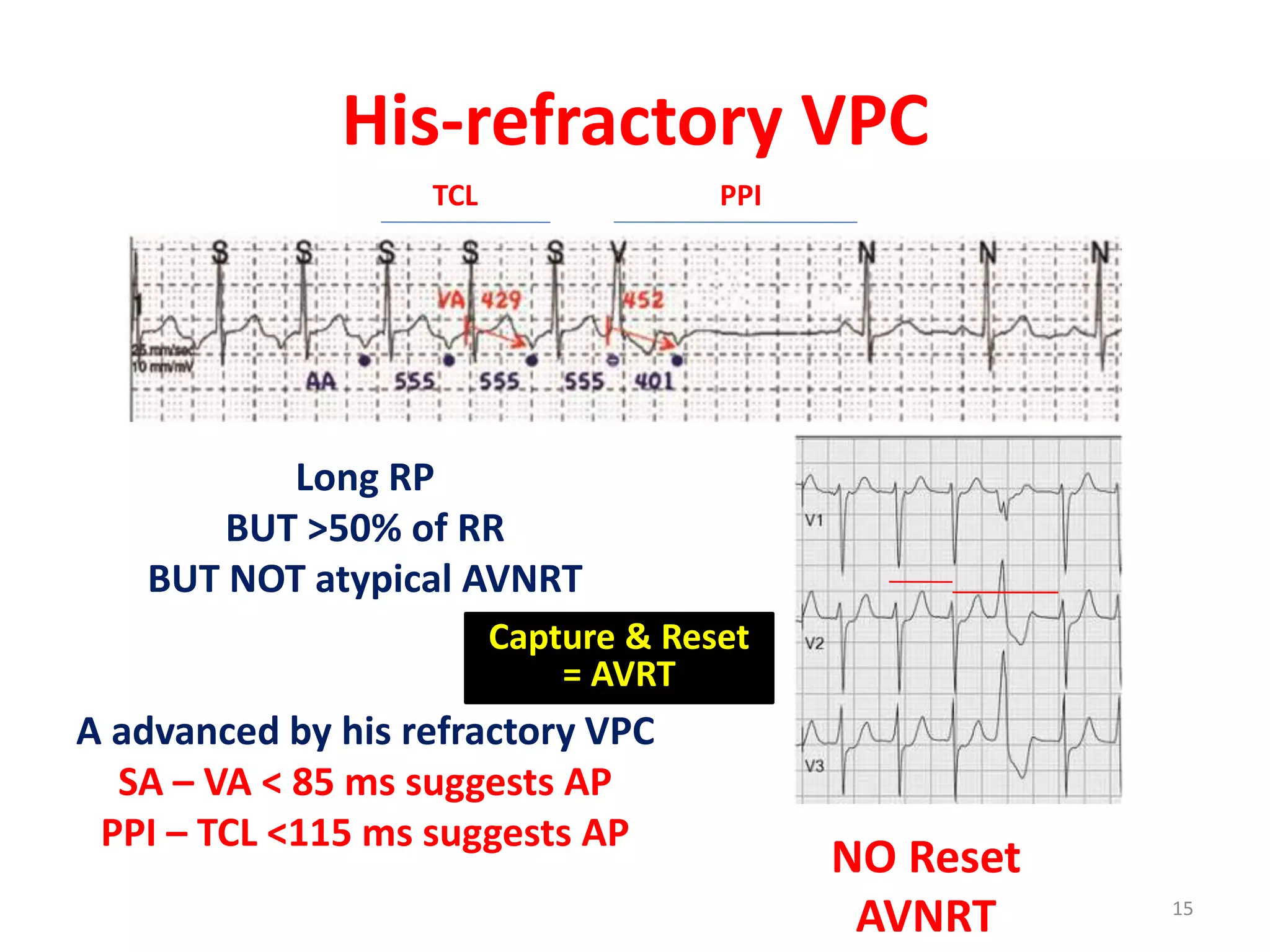 Supraventricular tachycardia: ECG recognition and diagnosis | PPTX