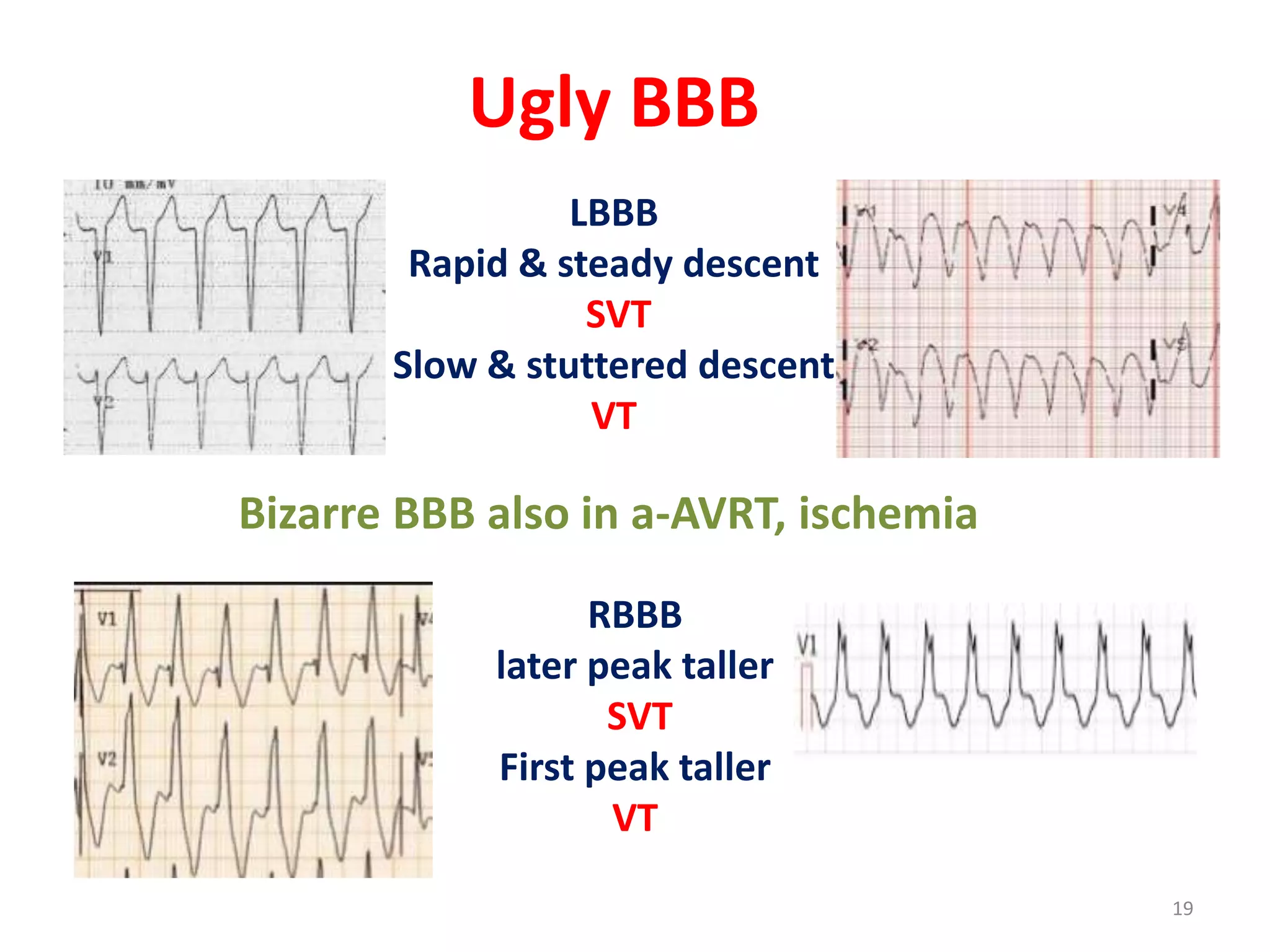 Supraventricular tachycardia: ECG recognition and diagnosis | PPTX