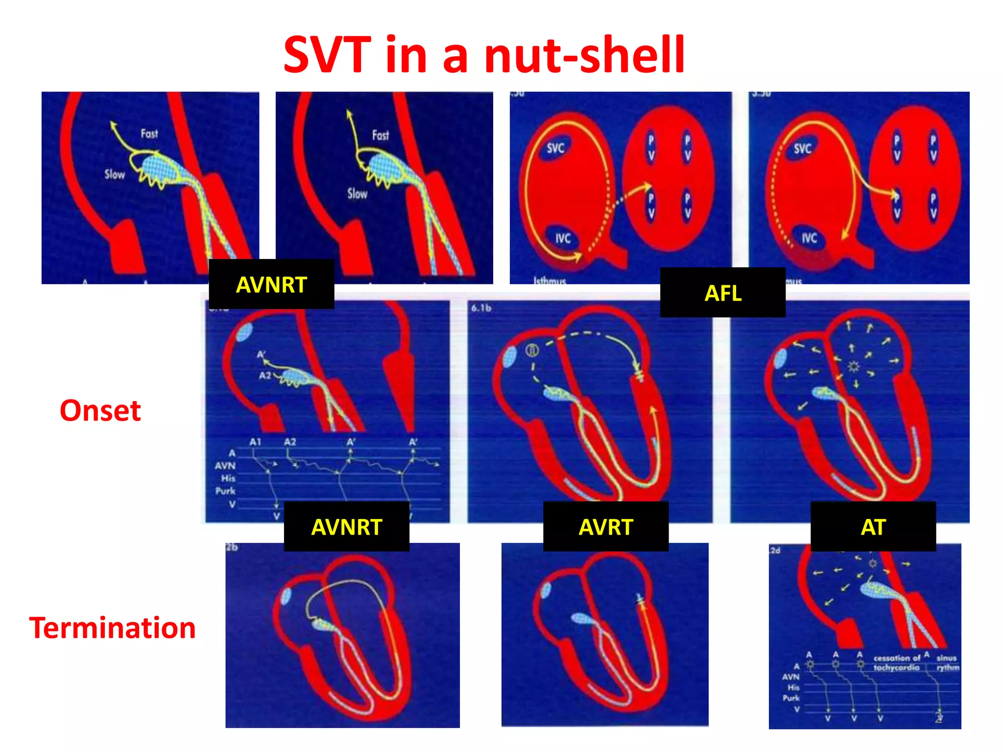 Supraventricular tachycardia: ECG recognition and diagnosis | PPTX