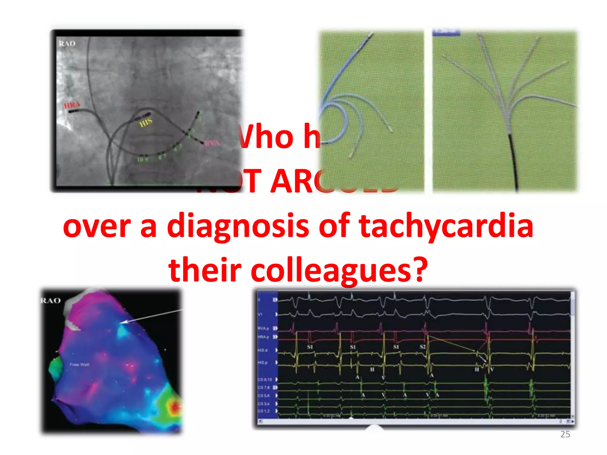 Supraventricular tachycardia: ECG recognition and diagnosis | PPTX