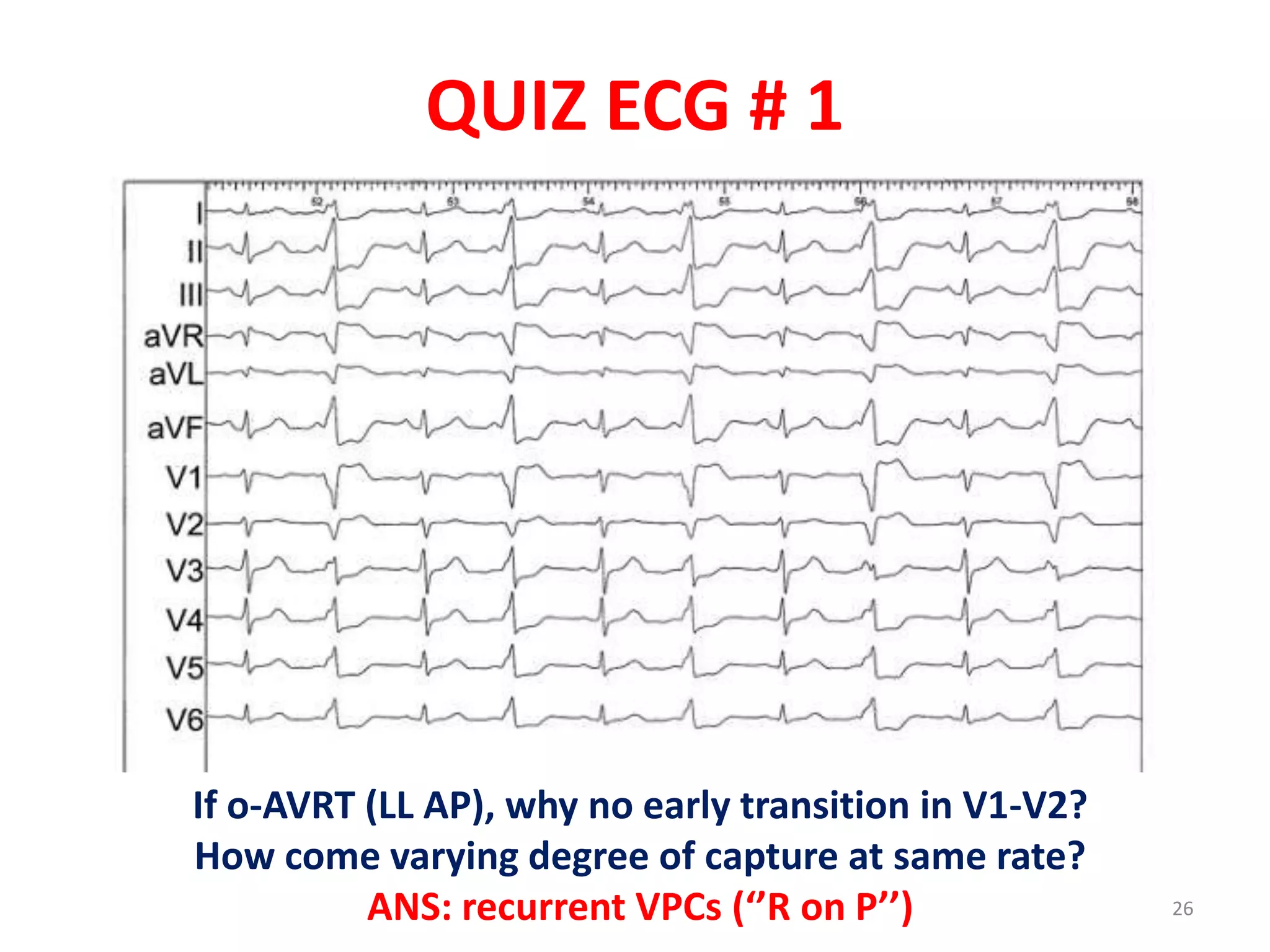 Supraventricular tachycardia: ECG recognition and diagnosis | PPTX