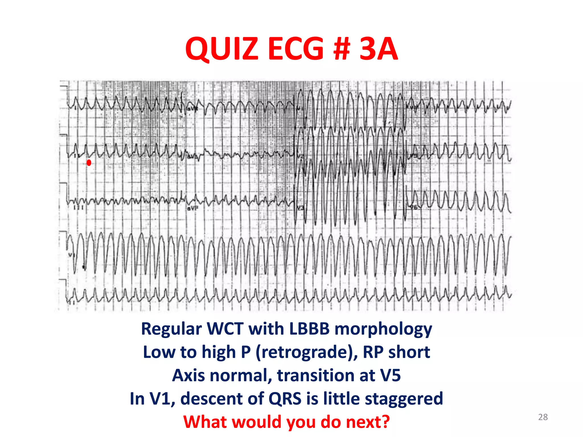 Supraventricular tachycardia: ECG recognition and diagnosis | PPTX