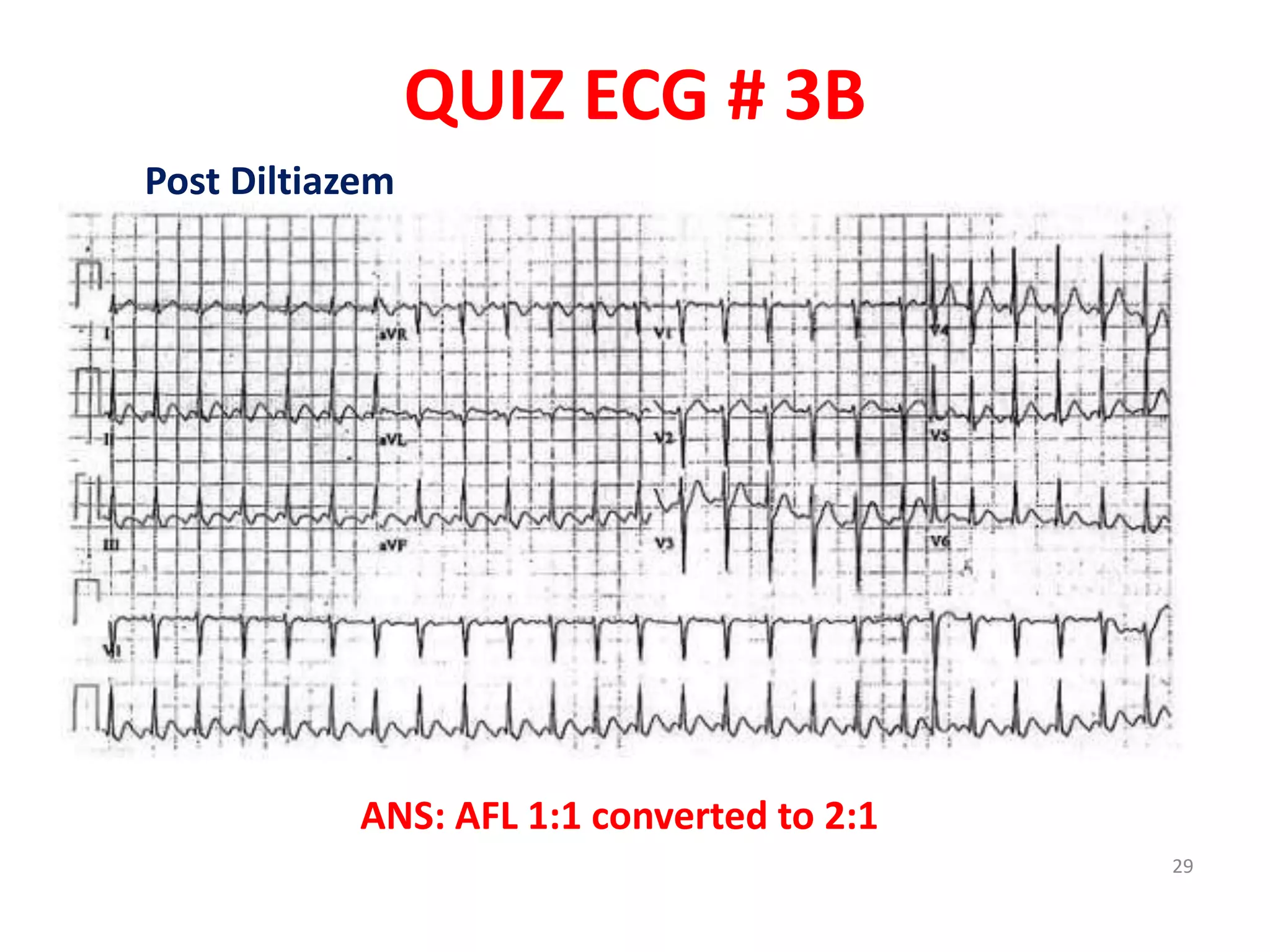 Supraventricular tachycardia: ECG recognition and diagnosis | PPTX