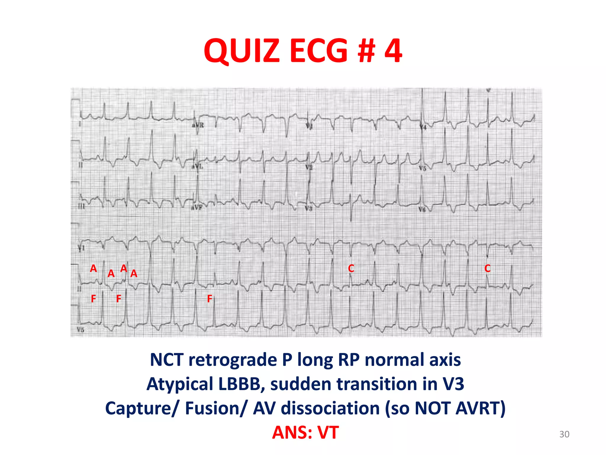 Supraventricular tachycardia: ECG recognition and diagnosis | PPTX
