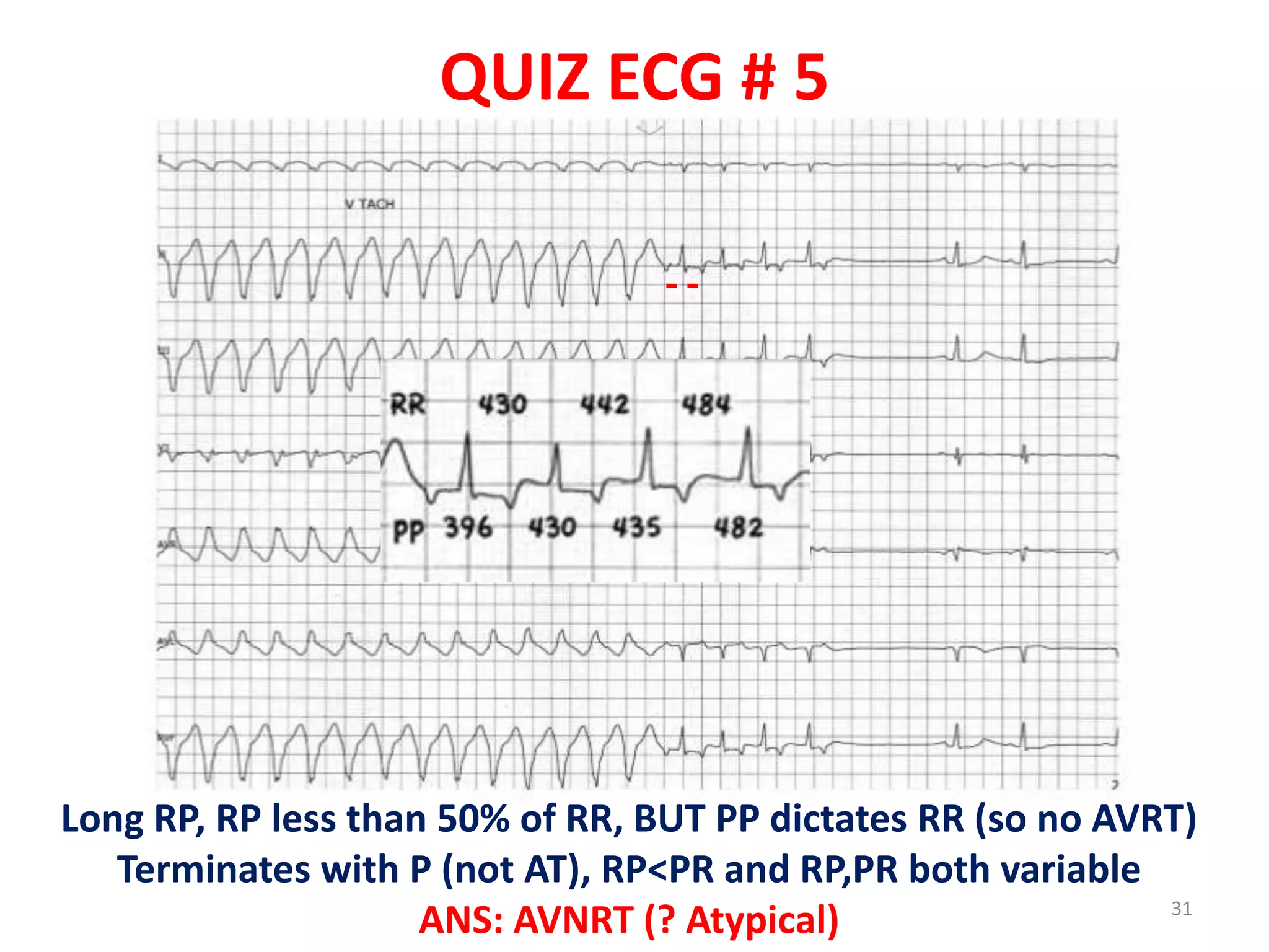Supraventricular tachycardia: ECG recognition and diagnosis | PPTX