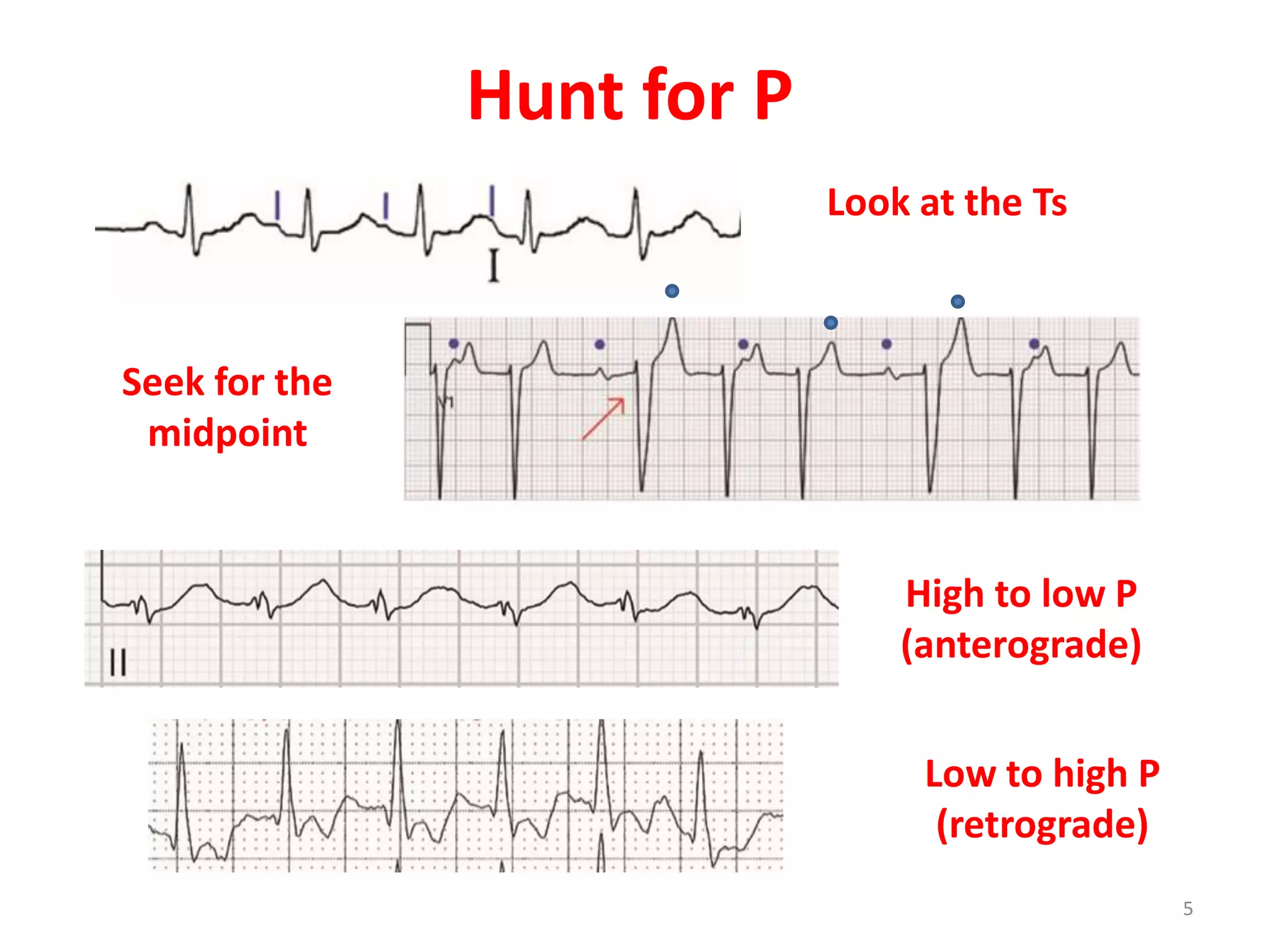 Supraventricular tachycardia: ECG recognition and diagnosis | PPTX