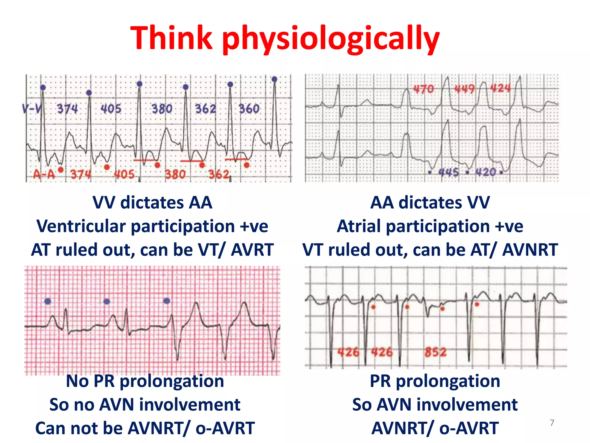 Supraventricular tachycardia: ECG recognition and diagnosis | PPTX