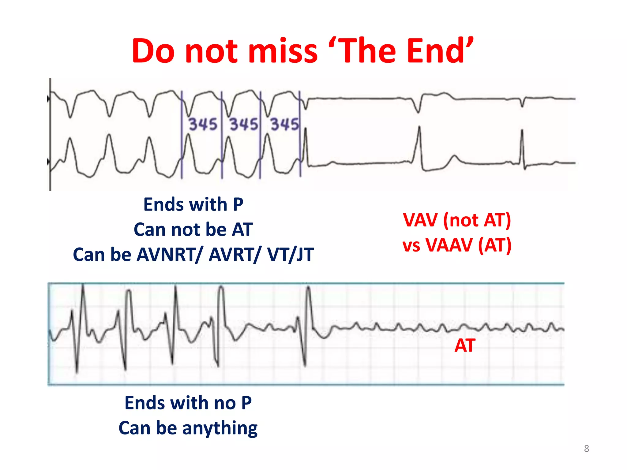 Supraventricular tachycardia: ECG recognition and diagnosis | PPTX