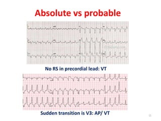 Supraventricular tachycardia: ECG recognition and diagnosis | PPTX