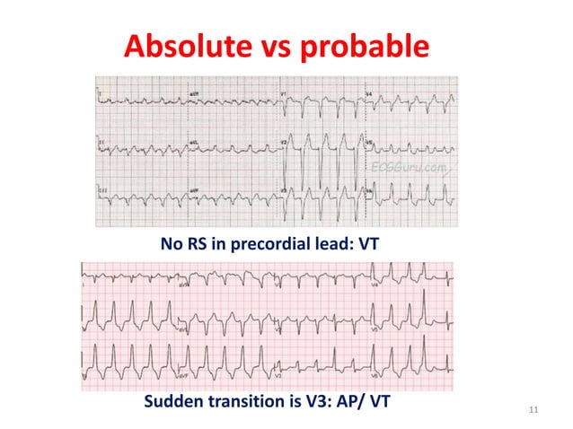 Supraventricular tachycardia: ECG recognition and diagnosis | PPTX