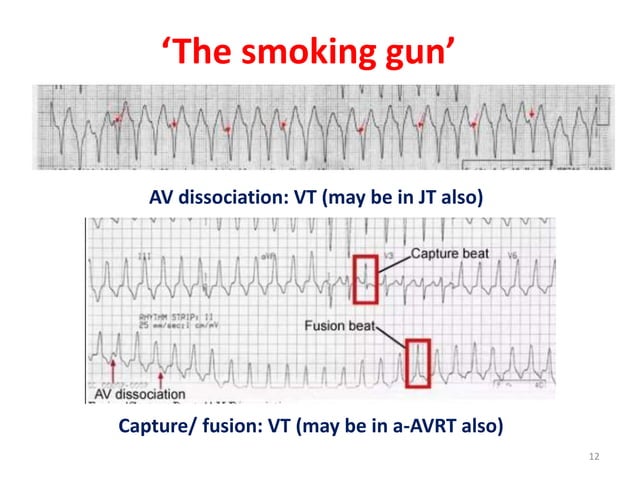 Supraventricular tachycardia: ECG recognition and diagnosis | PPTX