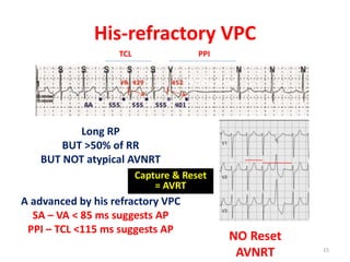 Supraventricular tachycardia: ECG recognition and diagnosis | PPTX