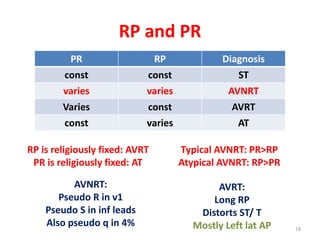 Supraventricular tachycardia: ECG recognition and diagnosis | PPTX