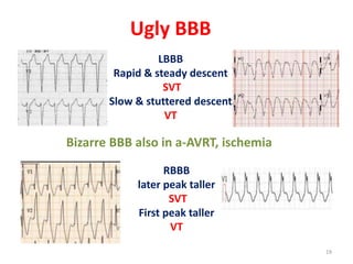 Supraventricular tachycardia: ECG recognition and diagnosis | PPTX