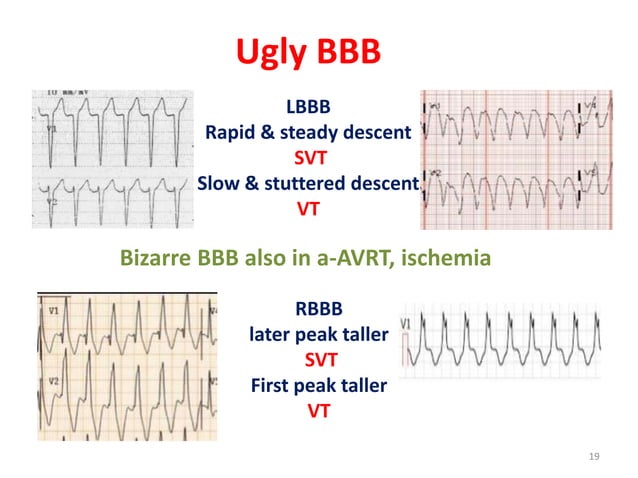 Supraventricular tachycardia: ECG recognition and diagnosis | PPTX