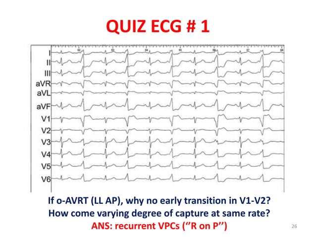 Supraventricular tachycardia: ECG recognition and diagnosis | PPTX