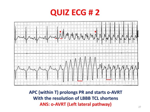 Supraventricular tachycardia: ECG recognition and diagnosis | PPTX
