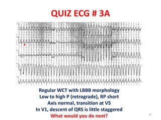 Supraventricular tachycardia: ECG recognition and diagnosis | PPTX