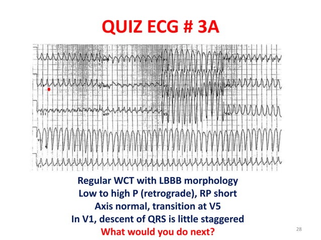 Supraventricular tachycardia: ECG recognition and diagnosis | PPTX
