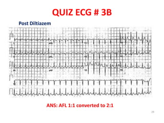 Supraventricular tachycardia: ECG recognition and diagnosis | PPTX