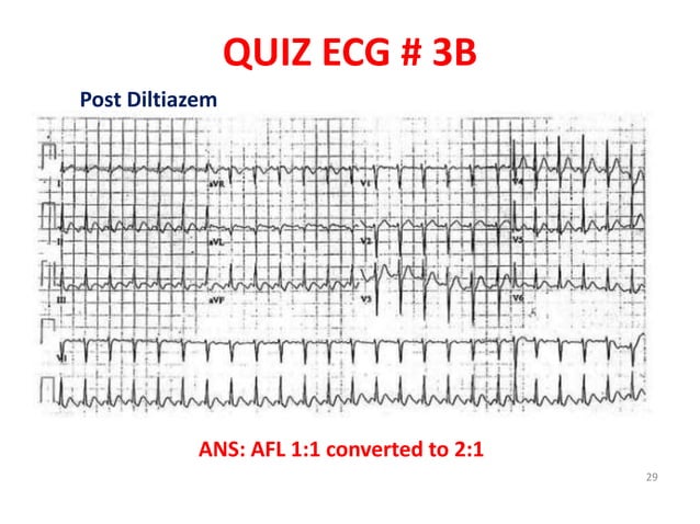 Supraventricular tachycardia: ECG recognition and diagnosis | PPTX