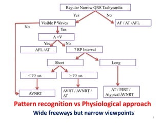Supraventricular tachycardia: ECG recognition and diagnosis | PPTX