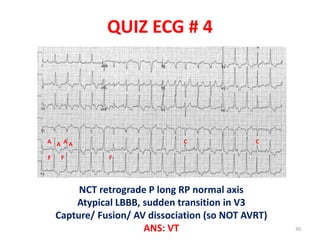 Supraventricular tachycardia: ECG recognition and diagnosis | PPTX