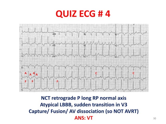 Supraventricular tachycardia: ECG recognition and diagnosis | PPTX