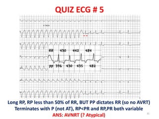 Supraventricular tachycardia: ECG recognition and diagnosis | PPTX
