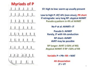 Supraventricular tachycardia: ECG recognition and diagnosis | PPTX