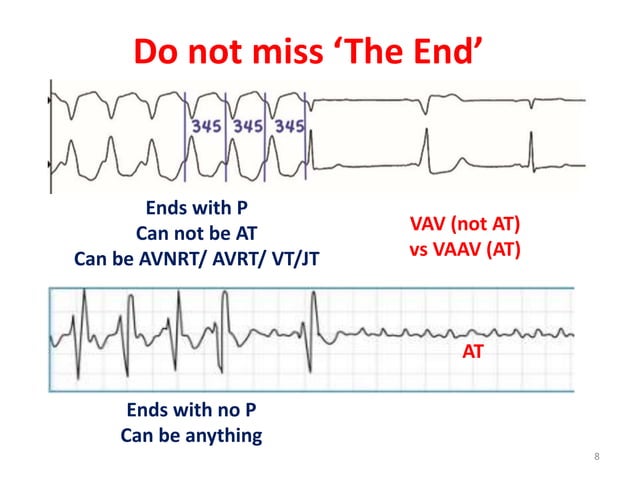 Supraventricular tachycardia: ECG recognition and diagnosis | PPTX