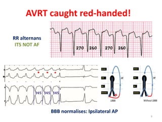 Supraventricular tachycardia: ECG recognition and diagnosis | PPTX