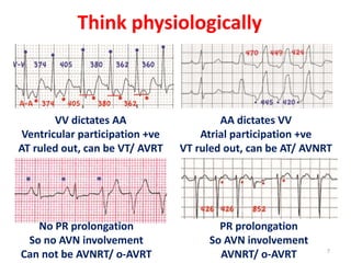 Supraventricular tachycardia: ECG recognition and diagnosis | PPT