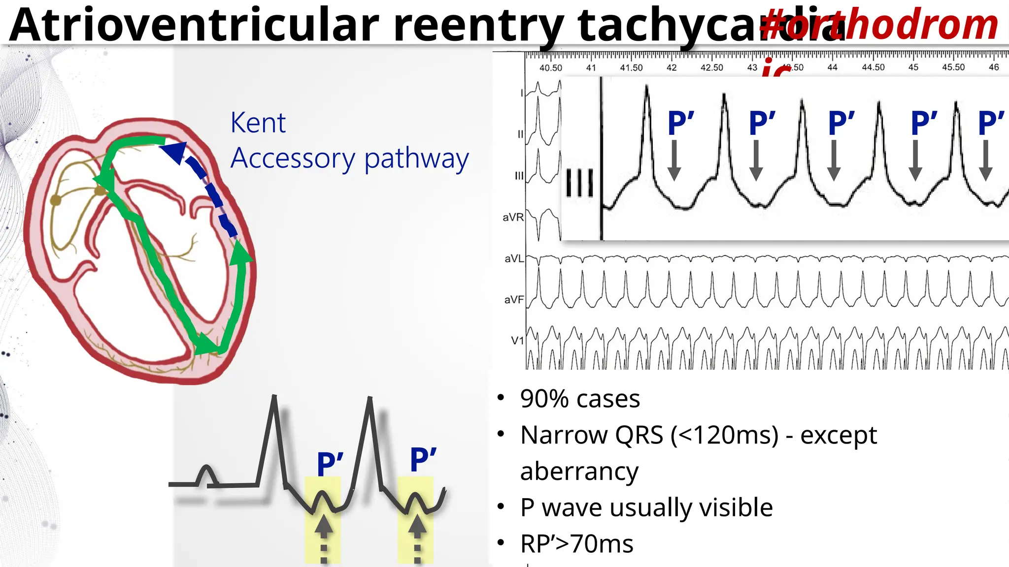 Supraventicular tachycardias ECG and diagnosis | PPT