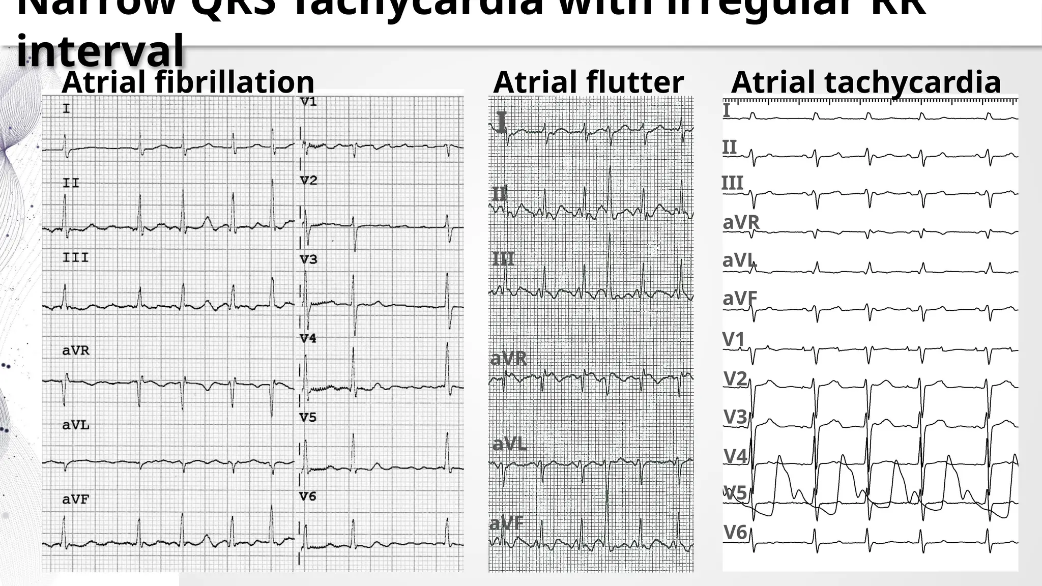 Supraventicular tachycardias ECG and diagnosis | PPT