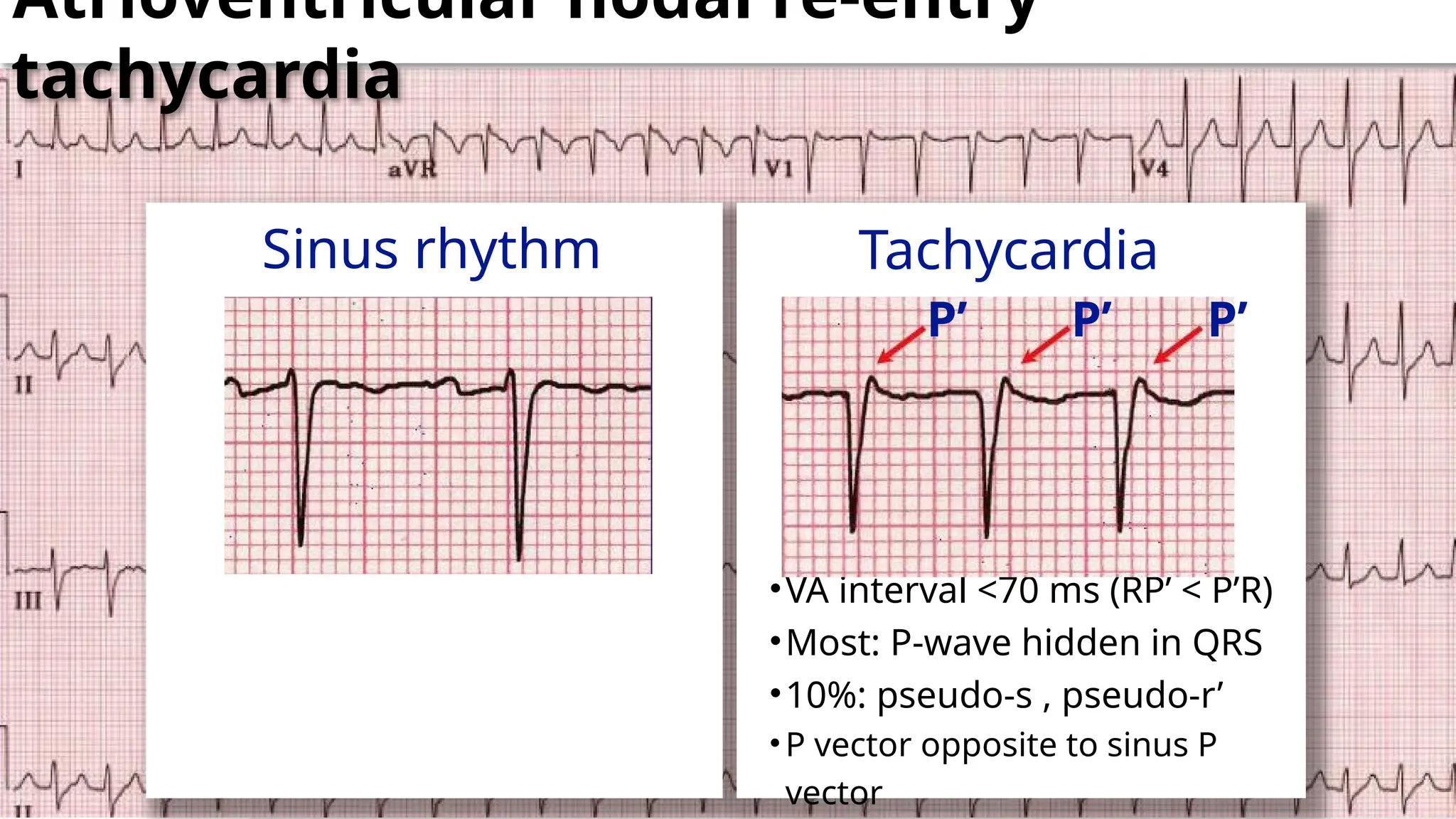 Supraventicular tachycardias ECG and diagnosis | PPT