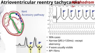 Supraventicular tachycardias ECG and diagnosis | PPT