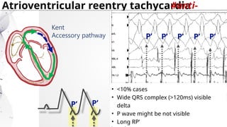 Supraventicular tachycardias ECG and diagnosis | PPT