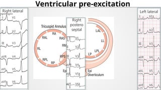 Supraventicular tachycardias ECG and diagnosis | PPT