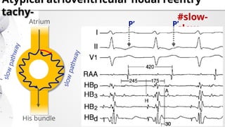 Supraventicular tachycardias ECG and diagnosis | PPT