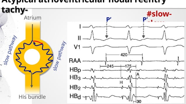Supraventicular tachycardias ECG and diagnosis | PPT