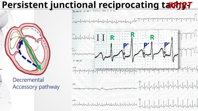 Supraventicular tachycardias ECG and diagnosis | PPT