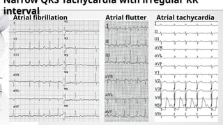 Supraventicular tachycardias ECG and diagnosis | PPT
