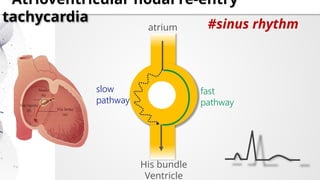 Supraventicular tachycardias ECG and diagnosis | PPT