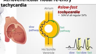 Supraventicular tachycardias ECG and diagnosis | PPT