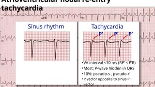 Supraventicular tachycardias ECG and diagnosis | PPT