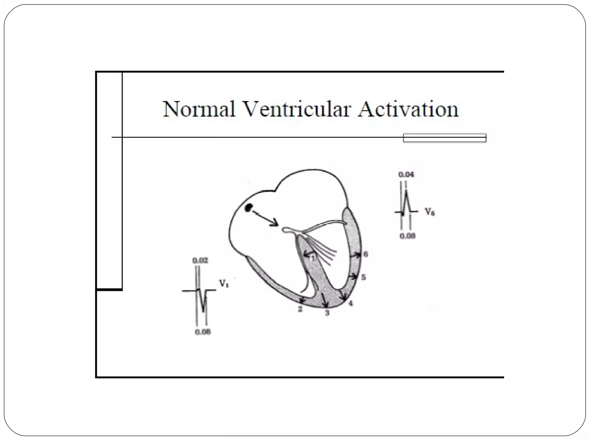 supraventricular tachycardia (SVT) with aberrancy | PPT