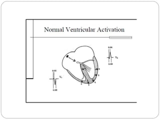 supraventricular tachycardia (SVT) with aberrancy | PPT