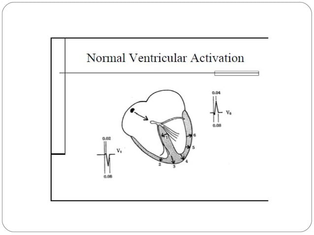 supraventricular tachycardia (SVT) with aberrancy | PPT